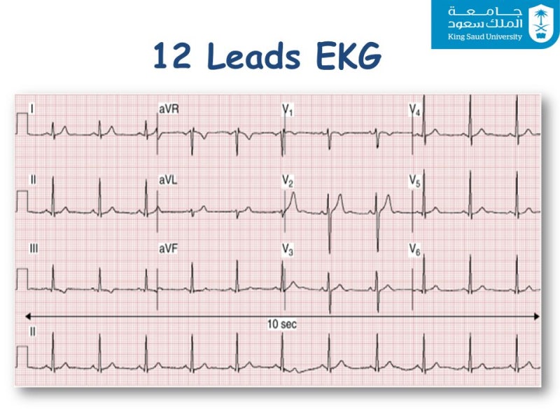 [순환기계8-4] 기본 심전도의 이해(Basic EKG,ECG) 2-1 : 네이버 블로그