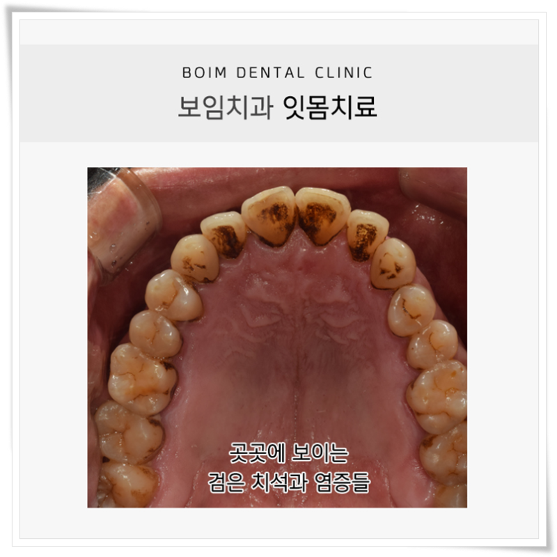 만성 치주염 치료 잇몸치료종류스케일링치근활택술치주소파술 네이버 블로그
