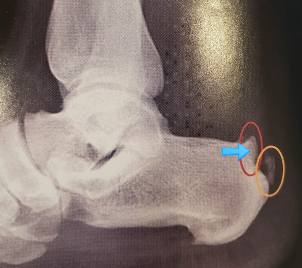 광화문 통증의학과- 발뒤꿈치 통증- 하글런드변형(Haglund deformity) : 네이버 블로그