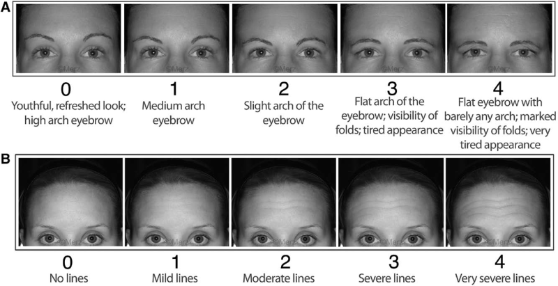 [ 보톡스 ] 보톡스로 처진눈썹 올리기 - 송파동, 석촌동, 가락동/헬리오시티피부과 : 네이버 블로그