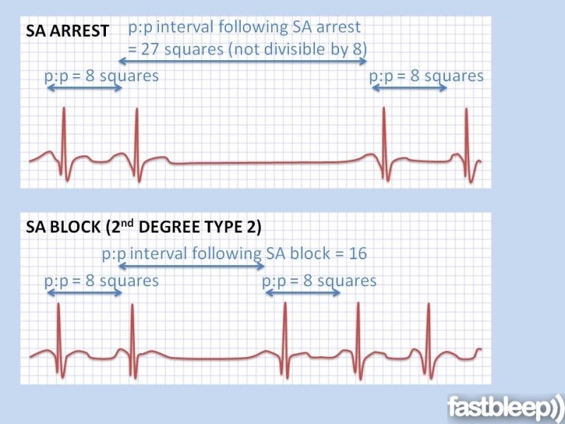 [순환기계8-7] 부정맥(arrhythmia) 2-2 : 네이버 블로그