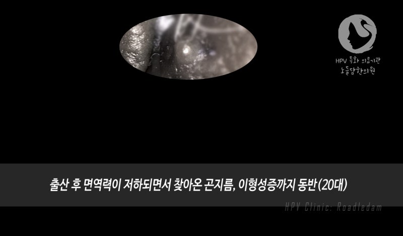 자궁경부 Lsil 저등급편평상피내병변 사례 네이버 블로그
