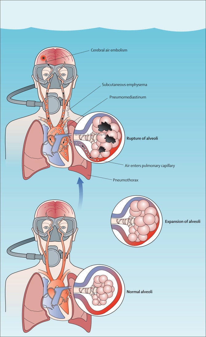 감압병(Decompression sickness) : 네이버 블로그