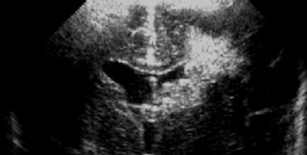 Brain SONO : 뇌실내 출혈 및 뇌실주위 백질 연화증 : 네이버 블로그