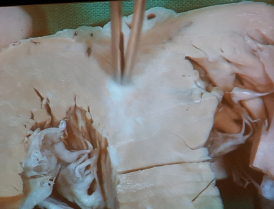 심근경색 (Myocardial infacrtion)LAD MI : 네이버 블로그