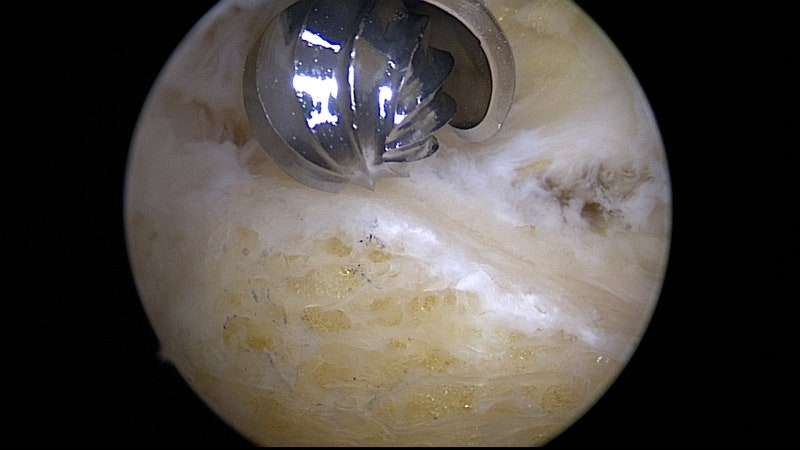하글런드병(Haglund`s disease, 아킬레스건염)에서의 관절경적 골극 절제 및 염증제거술/올바른서울병원 조재호 ...
