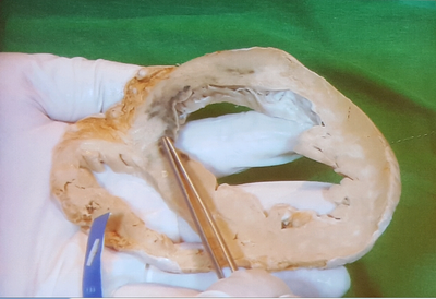 심근경색 (Myocardial infacrtion)LAD MI : 네이버 블로그