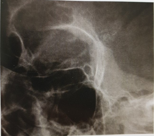 optic foramen orbitoparietal oblique projection = 변형된 Rhese법 : 네이버 블로그