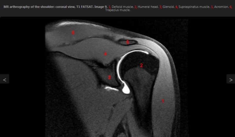 MR Arthrogram(관절조영 MRI검사) : 네이버 블로그