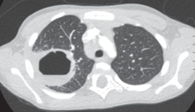 농흉(empyema)과 폐농양(lung abscess) 감별: CT 소견, split pleural sign : 네이버 블로그