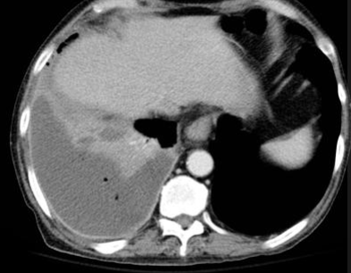 농흉(empyema)과 폐농양(lung abscess) 감별: CT 소견, split pleural sign : 네이버 블로그