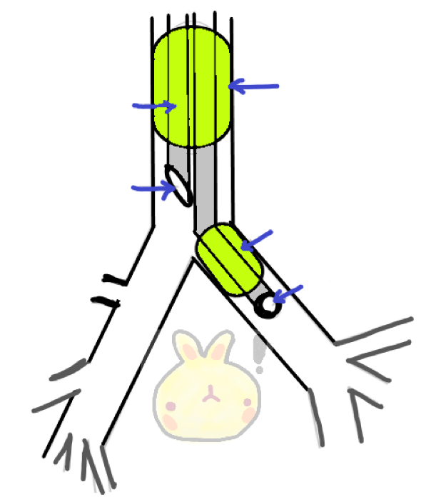 Double-lumen endotracheal tube (DLT, 이중관 기관내튜브) : 네이버 블로그