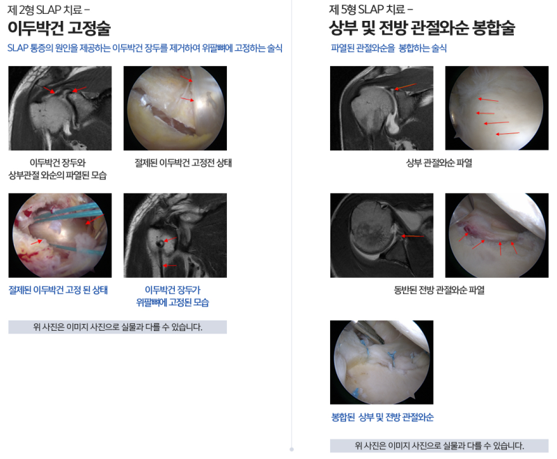 어깨 Slap병변 원인 어깨가 너무 아파요 네이버 블로그