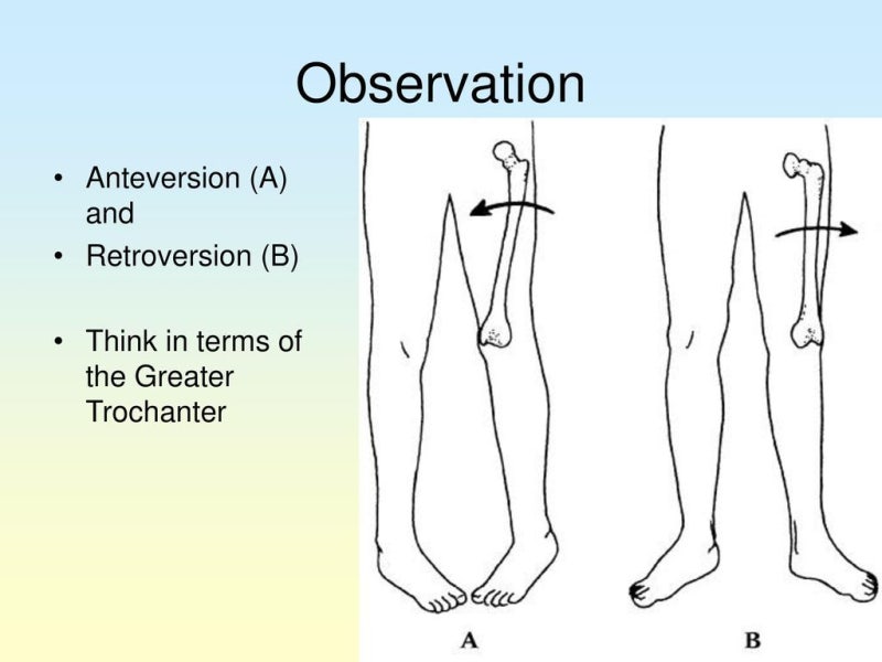 [족부학 15]대퇴골의 전경( Femoral anterversion ) : 네이버 블로그