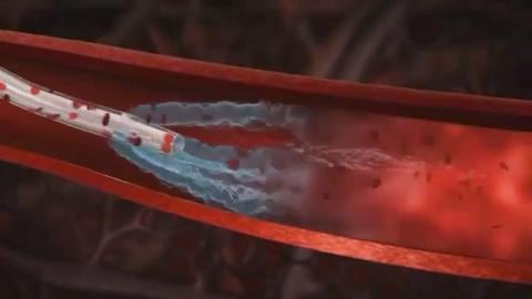 [지노메디] BD 넥시바 디퓨직스(Nexiva Diffusics) 제품 소개 : 네이버 블로그