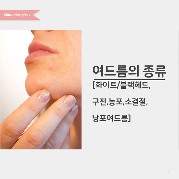 여드름의 종류 화이트블랙헤드구진농포소결절낭포여드름 네이버 블로그