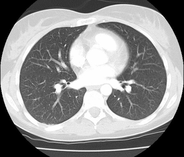 Chest CT : 네이버 블로그