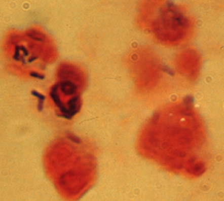 소아 뇌수막염에서 그람 염색과 특징, Gram stain, characteristic features, bacterial ...