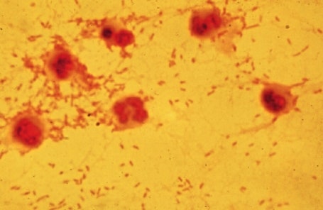 소아 뇌수막염에서 그람 염색과 특징, Gram stain, characteristic features, bacterial ...