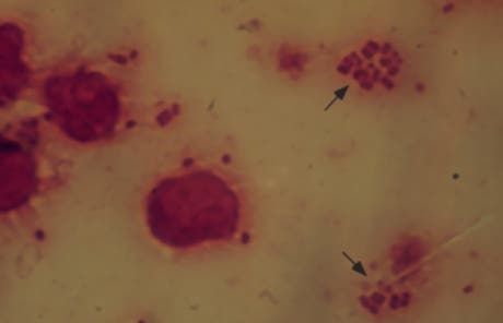 소아 뇌수막염에서 그람 염색과 특징, Gram stain, characteristic features, bacterial ...