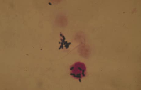 소아 뇌수막염에서 그람 염색과 특징, Gram stain, characteristic features, bacterial ...
