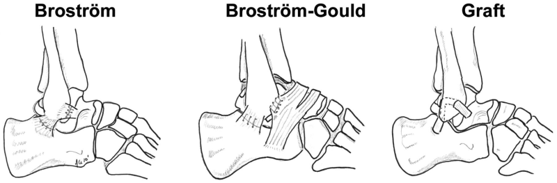 발목 외측인대 수술(modified brostrom repair) : 네이버 블로그