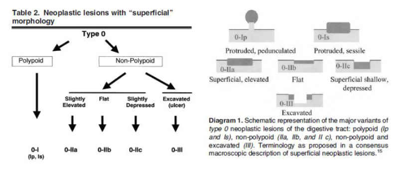 Paris classification system of superficial gastrointestinal neoplastic ...