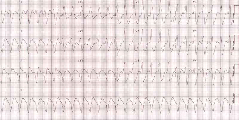 Pulseless Ventricular Tachycardia Ecg