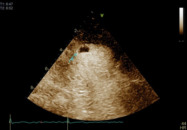 sonovue contrast echo-thrombus in LV cap : 네이버 블로그