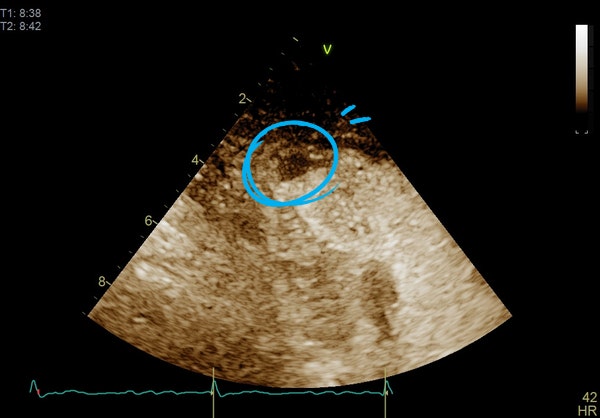 sonovue contrast echo-thrombus in LV cap : 네이버 블로그