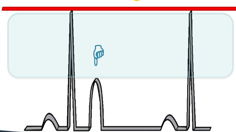 Temporary Pacemaker, 임시형 심박동기 간략 정리 : 네이버 블로그