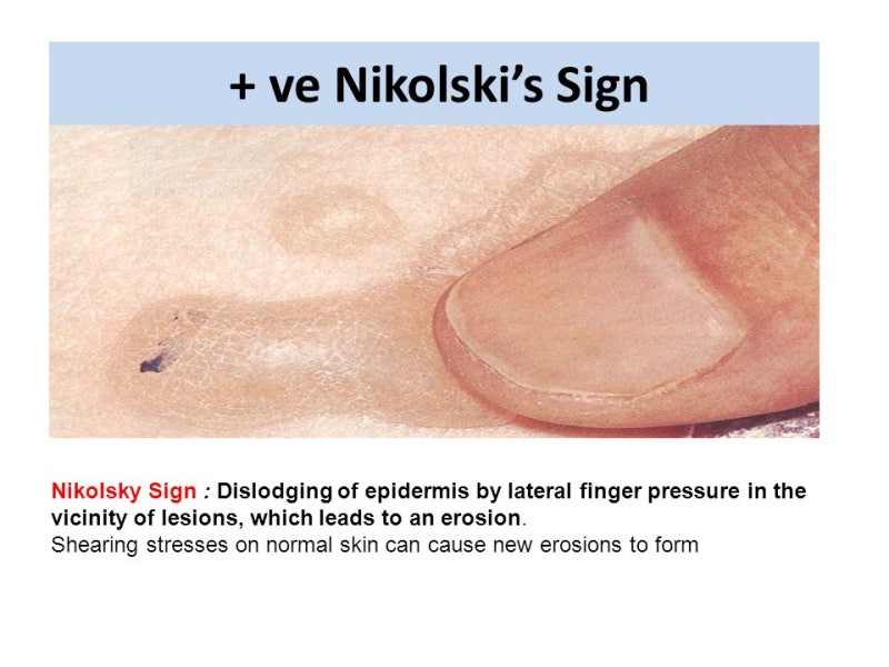 스티븐 존슨 증후군 Stevens-Johnson syndrome, SJS : 네이버 블로그