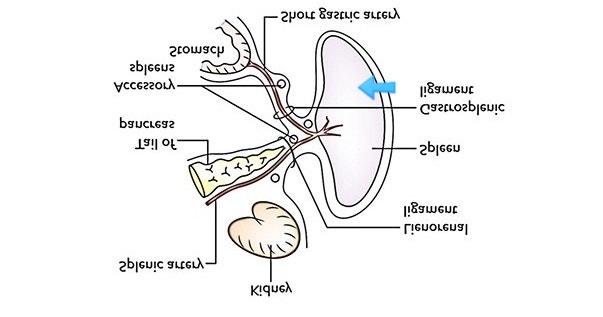 우연히 초음파에서 관찰되는 부비장, 부속비장 accessory spleen, 위비장 인대 gastrosplenic ...