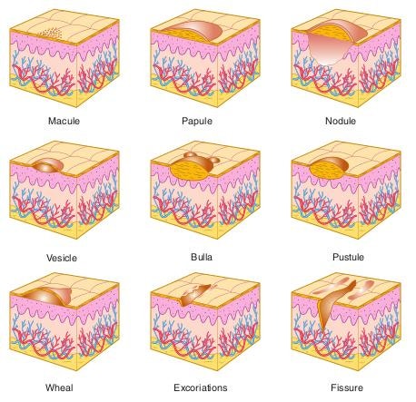 피부병변 기술 용어: 반점 macule, 구진 papules, 결절 nodules : 네이버 블로그
