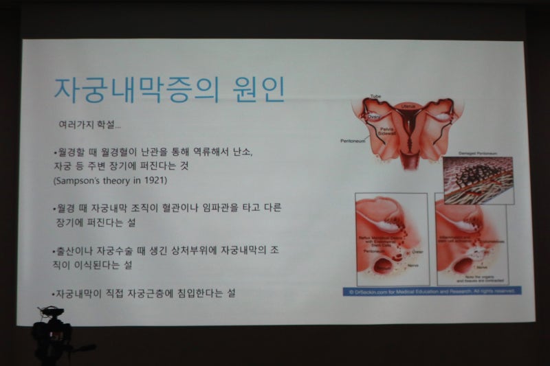 민트병원 Mgr 생리통의 원인 자궁내막증 증상과 치료 심한생리통 골반통 요통 부정출혈 네이버 블로그