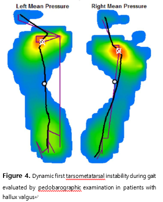 족부 압력 검사의 임상적 응응(Pedobarograph) : 네이버 블로그