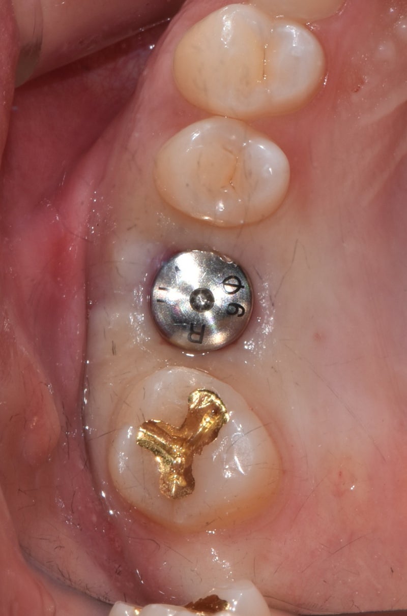 무절개 임플란트 식립 (feat. 누공, fistula) : 네이버 블로그