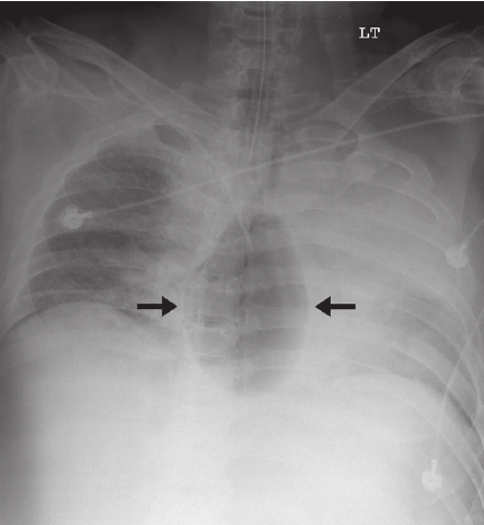 SB-tube (Sengstaken-Blakemore tube) : 네이버 블로그