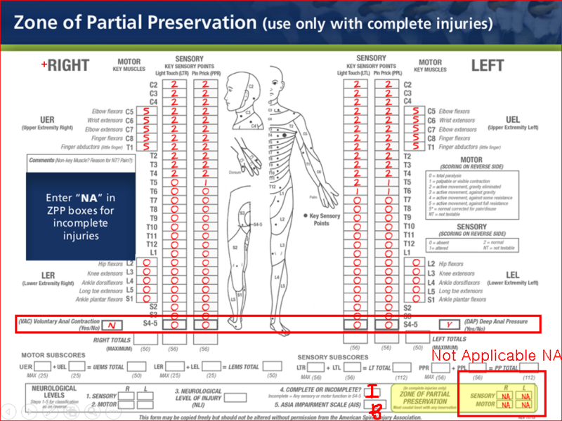 ISNCSCI 쉽게 이해하기(ASIA scale) - #4 완전손상 l 불완전손상 l ASIA level l ZPP란 무엇 ...