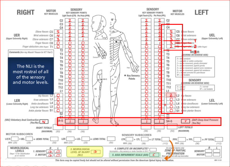 ISNCSCI 쉽게 이해하기(ASIA scale) - #4 완전손상 l 불완전손상 l ASIA level l ZPP란 무엇 ...