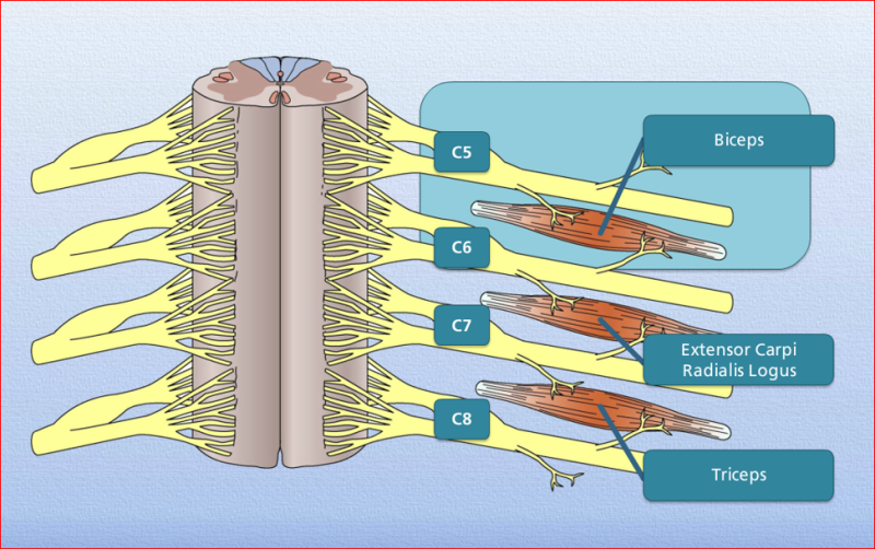 ISNCSCI 쉽게 이해하기(ASIA scale) - #3 Sensory, Motor level & NLI of SCI ...