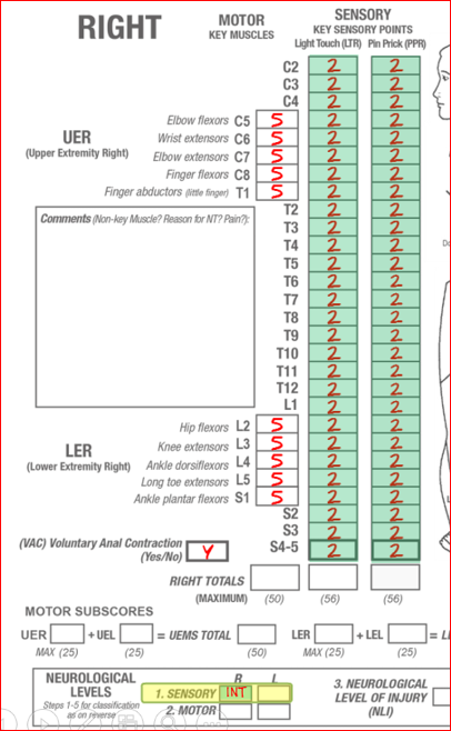 ISNCSCI 쉽게 이해하기(ASIA scale) - #3 Sensory, Motor level & NLI of SCI ...