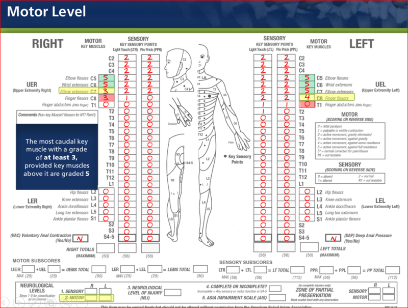 ISNCSCI 쉽게 이해하기(ASIA scale) - #3 Sensory, Motor level & NLI of SCI ...