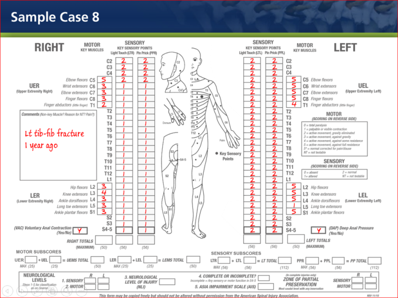 ISNCSCI 쉽게 이해하기(ASIA scale) - #5 Sample case : 네이버 블로그