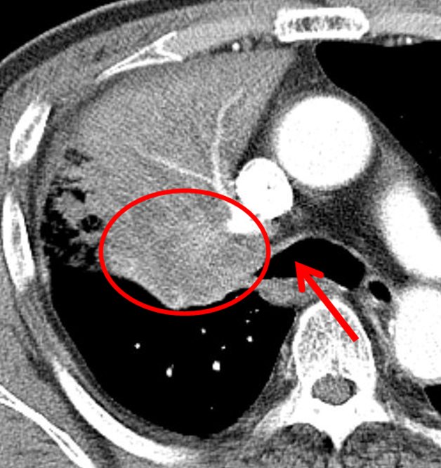 Reverse S/Golden S sign: Central lung cancer(중심성 폐암) Chest X-ray와 CT 소견 ...