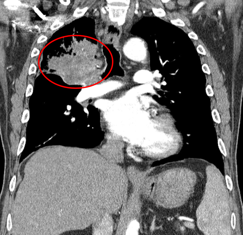Reverse S/Golden S sign: Central lung cancer(중심성 폐암) Chest X-ray와 CT 소견 ...