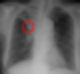 Reverse S/Golden S sign: Central lung cancer(중심성 폐암) Chest X-ray와 CT 소견 ...