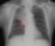 Reverse S/Golden S sign: Central lung cancer(중심성 폐암) Chest X-ray와 CT 소견 ...