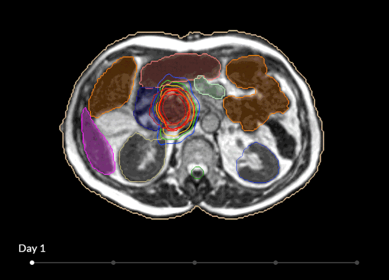 ViewRay MRIdian Linac (뷰레이)이란? : 네이버 블로그