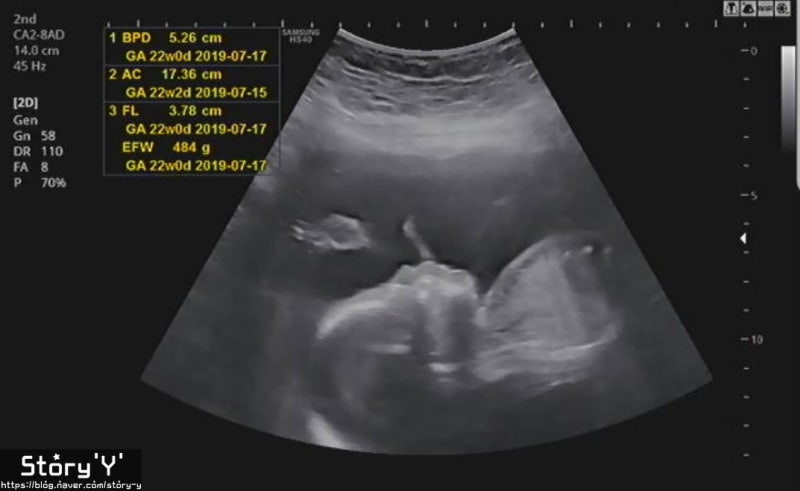 초음파 성별 각도법 태아각도법 And 중국황실달력 성별 구분법 임신 14주 여자아이 초음파 네이버 블로그